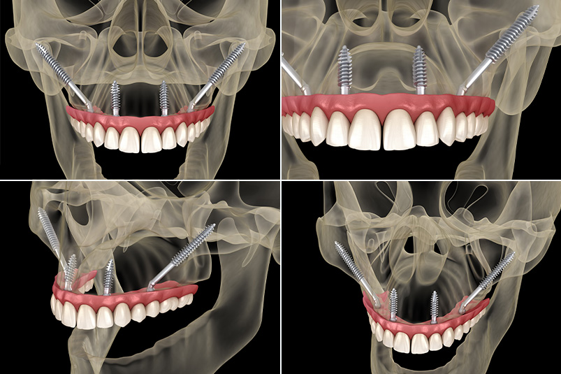 Zygomatic Implants Treatment In Mulund - Niraamay Dental Care